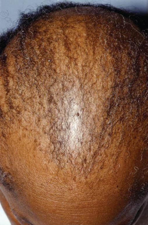 Hair Loss in African Americans: Best Trichologist for Black Hair